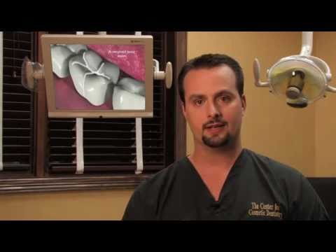 What is a Dental Sealant - Lakeway Center for Cosmetic and Family Dentistry