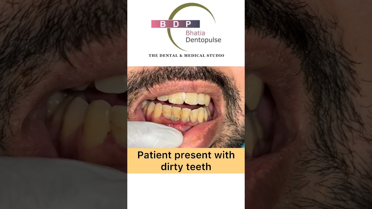 Dirty Teeth Smile Makeover: Teeth cleaning: Dr. Srishti Bhatia #teeth #smile