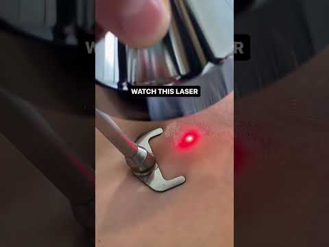 Watch Our Erbium Laser Erase These Stretch Marks 👀