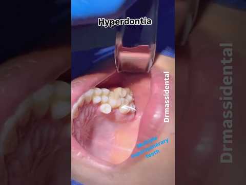 Hyperdontia, supernumerary teeth, Halloween,