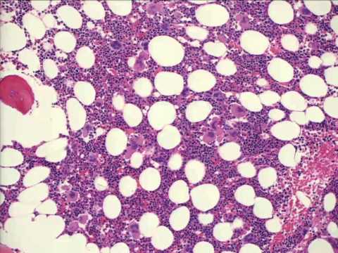Myeloproliferative Neoplasms in 2014: Morphology, Molecular Genetics, and Test Utilization