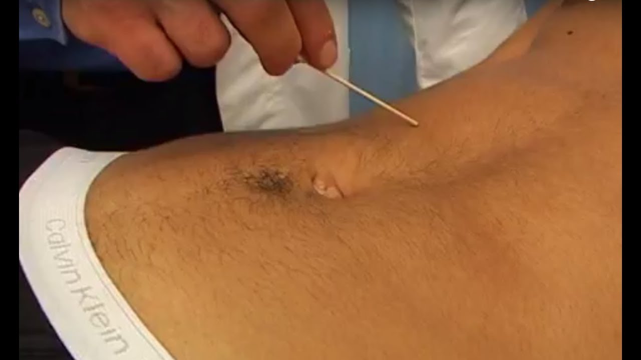 Abdominal reflex