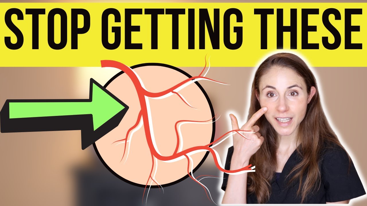 How To Stop Getting Broken Capillaries On The Face