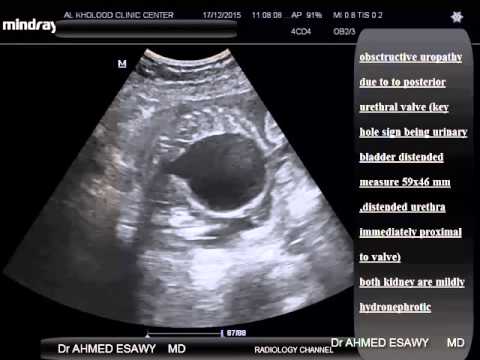 CASE 74 FETAL POSTERIOR URETHRAL VALVE PUV