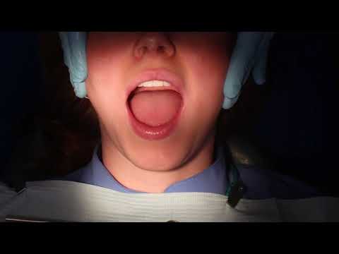 Oral Cancer Screening