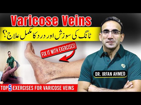 Say Goodbye to Varicose Vein Pain with These 5 Home Exercises Urdu|Hindi