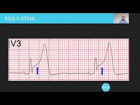 ECG (Part 5) STEMI - Australian Paramedical College