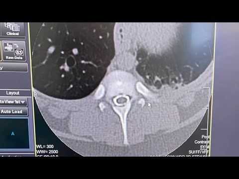 Post myelogram ct scan