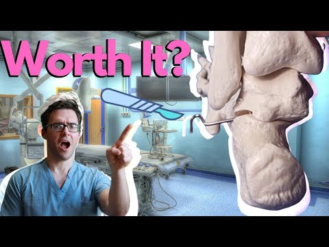 Is Flat Foot Surgery Worth It? [Recovery Time & REAL RESULTS]
