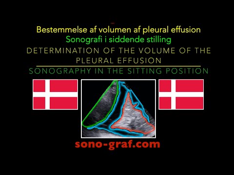 Sonografi i siddende stilling - Bestemmelse af volumen af pleural effusion