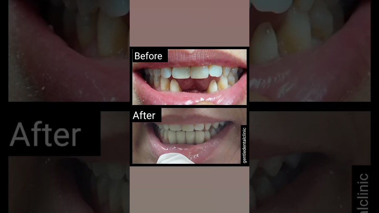 Missing Teeth replacement via crown