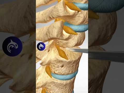 See how a Spinal Fusion Surgery (ACDF) works - 3D Animation