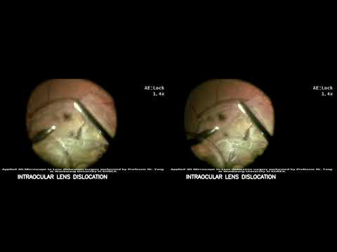 Intraocular lens dislocation