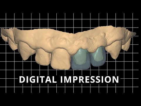 Natural Looking Crowns | Dental Crowns