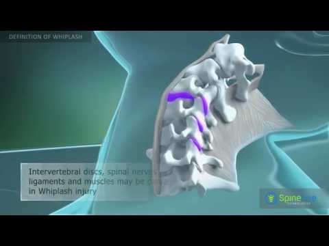 Whiplash Definition