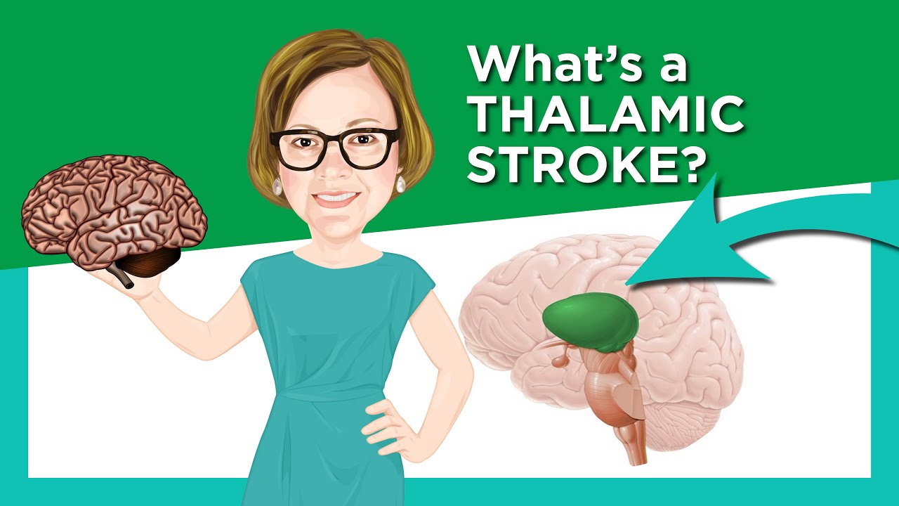 Calling all Thalamic stoke brothers & sisters - About stroke - Stroke ...