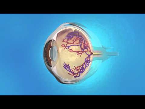 Medication Injections for ROP