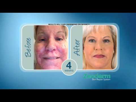 New Zeoderm System (120 Secs)