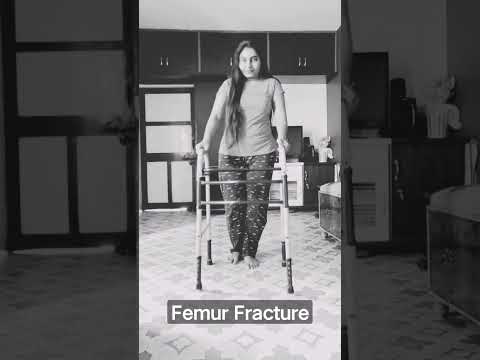 My Femur Fracture #shorts #shortvideo #youtubeshorts