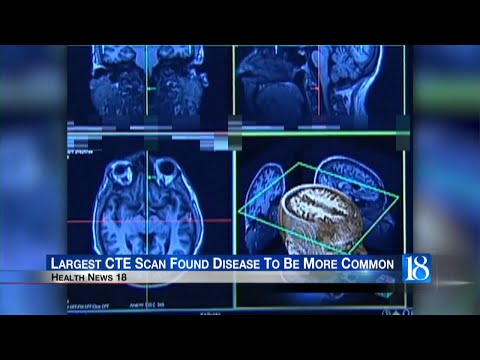 Largest CTE scan found disease to be more common