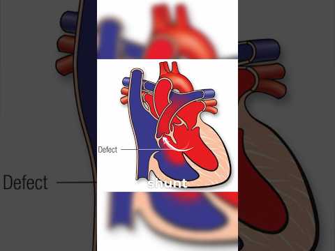 Eisenmenger Syndrome. #usmle
