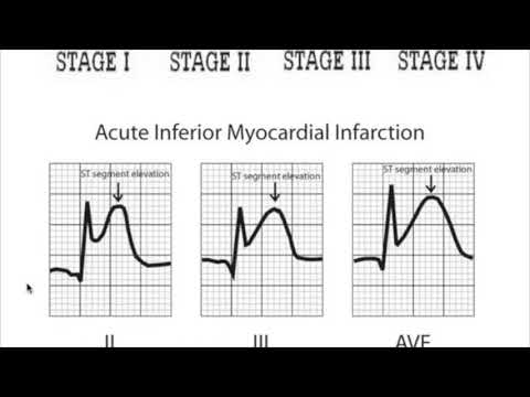 Myocardial Infarction Vs Ac. Pericarditis & Dressler syndrome