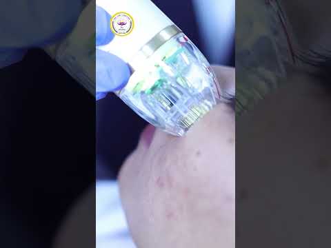 Acne-Scar Treatment | MNRF Treatment | #Dermatologist #Doctor #Skin