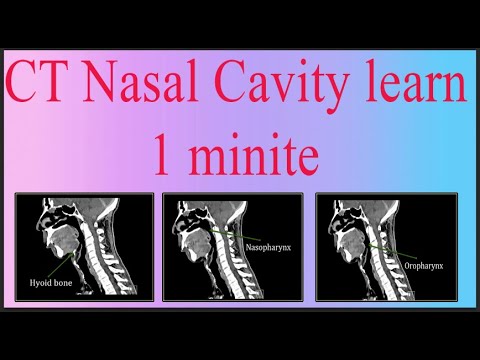 ct scan of nasal cavity