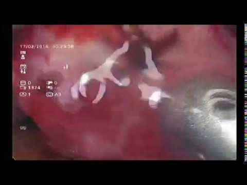 Lap Salpingotomy
