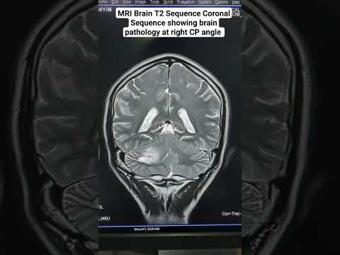 MRI Brain T2 Sequence Coronal Section #anatomy #beginners #medicalimaging #radiology #mri #diagnosis
