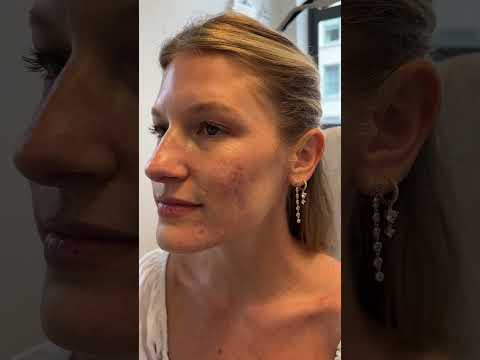 What laser treatments are best for acne scars?
