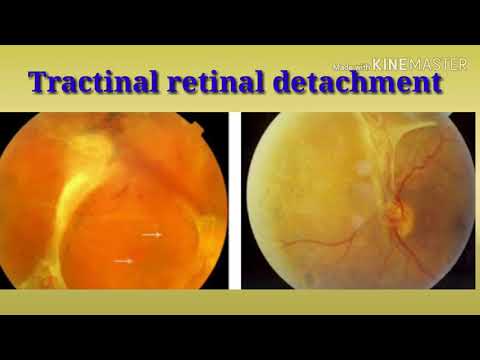 Tractional Retinal Detachment || Retinal detachment