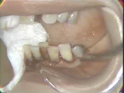 Exodontic Fundamentals - The Mandible