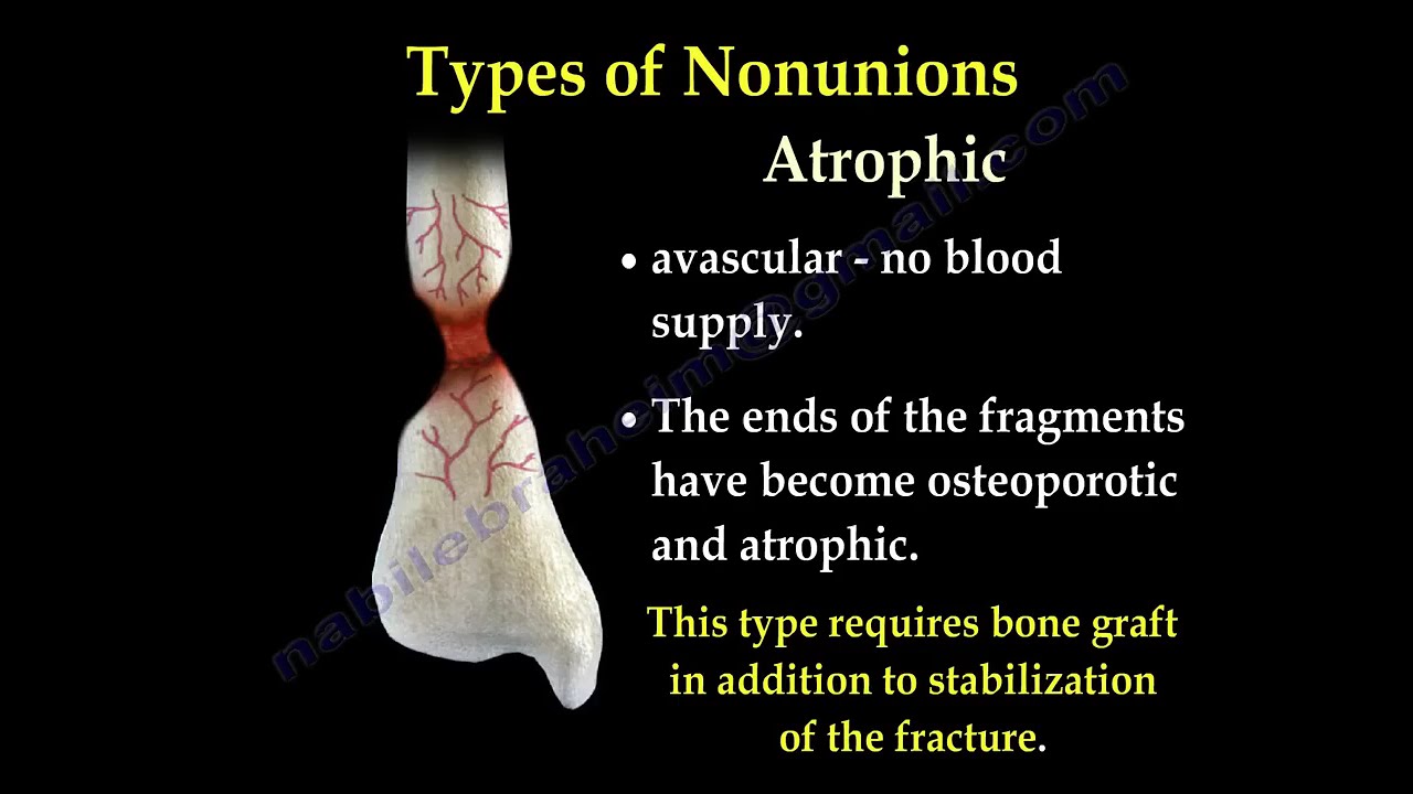 NONUNION OF FRACTURES CAUSES, TYPES AND TREATMENT