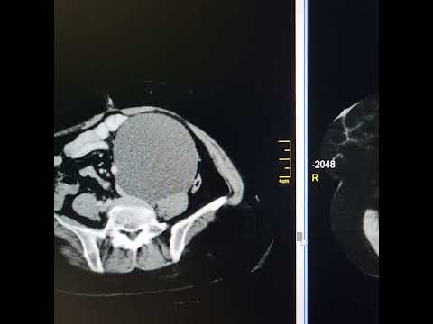 Left para aortic retroperitoneal cyst. Lymphocele?