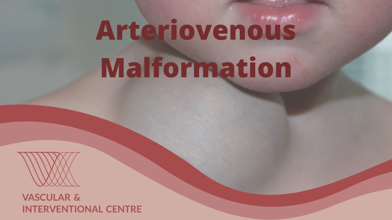 What is Arteriovenous Malformation? How can it be treated?