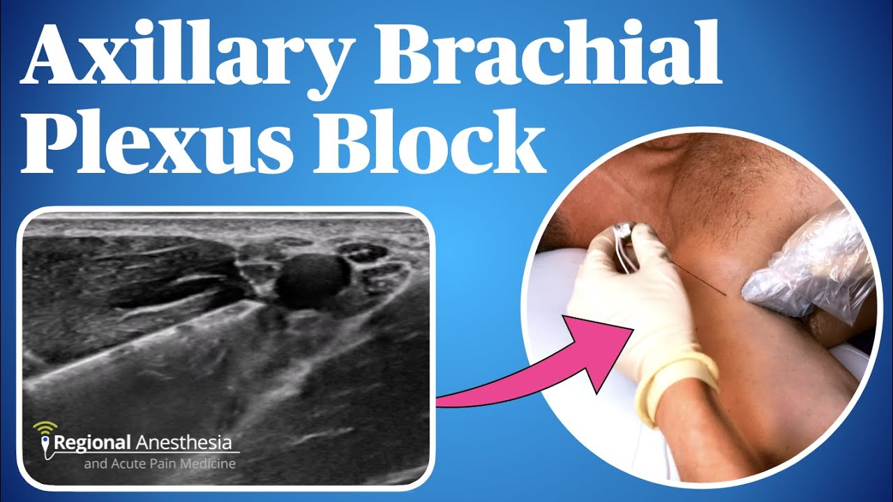 Axillary Brachial Plexus Block
