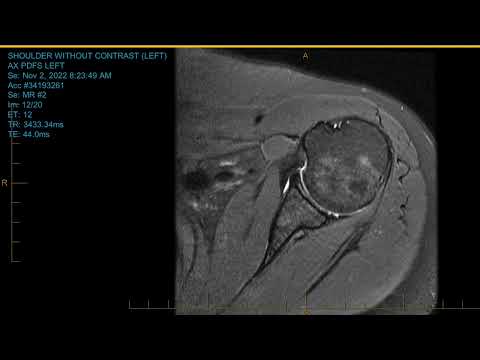 SLAP Tear MRI Left Shoulder