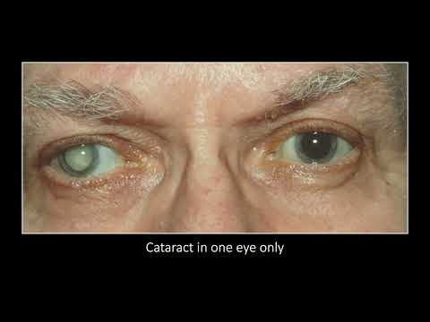 Peer2Peer | Ms Lucia Pelosini's Real World Experience with RayOne EMV & Trifocal IOLs