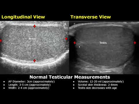 How To Measure Scrotum On Ultrasound | Testis, Epididymis AP Diameter, Length, Width & Volume USG