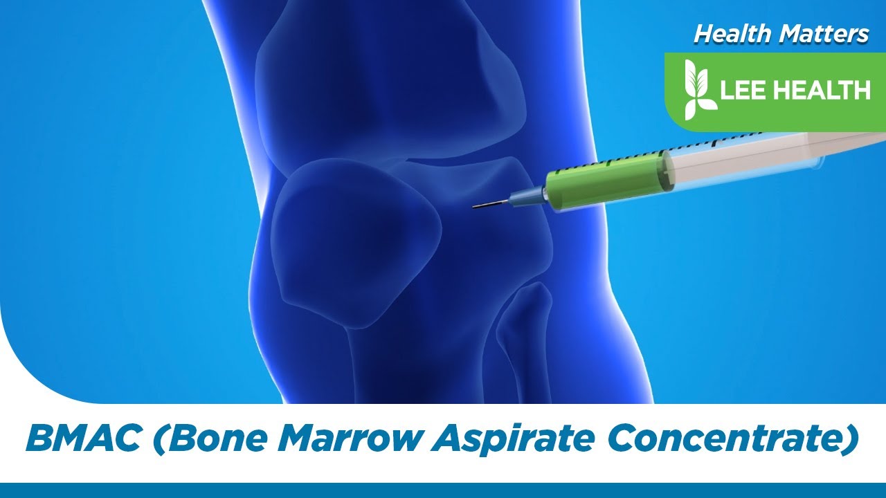 BMAC (Bone Marrow Aspirate Concentrate)