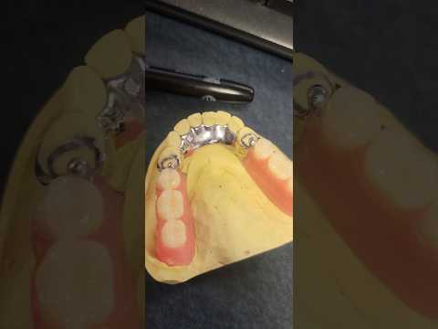 Best Partial denture Model Metal framework Acrylic Resin Base. #doctor #india