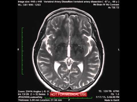 Vertebral Artery Dissection T2