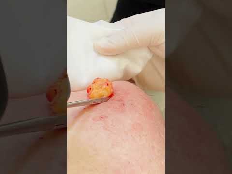 LARGE BACK LIPOMA!