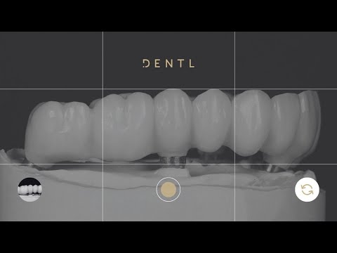 What Is The Cost Of All-Teeth-On-4 implants?