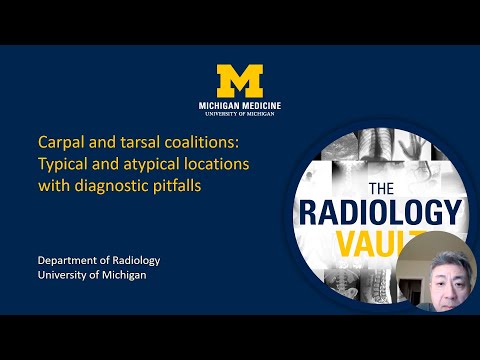 Carpal and Tarsal Coalitions