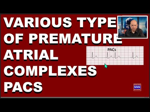 Atrial Premature Complexes PACs what you need to know Dr. Nik Nikam