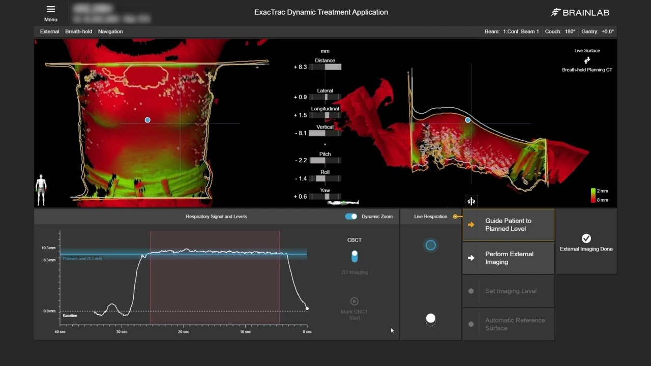 Exactrac Dynamic Breath Hold CBCT Workflow