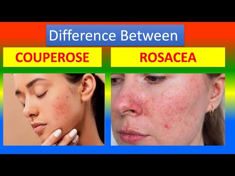 Difference Between Couperose and Rosacea