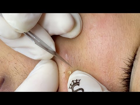 Teen Acne | Làm Sạch Mụn Cho Bạn Tuổi Teen - SacDepSpa#308